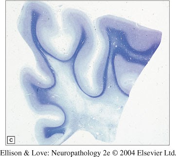 neuropathology blog: What's the deal with the subcortical U-fibers?