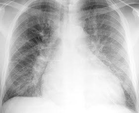Transposition of Great Vessels - Egg on String appearance