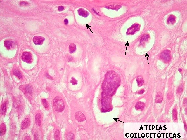 PaToLoGaNdO: Coilocitose
