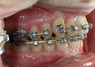 Orthodontic Corner: Non compliance first molar distalization, AmJO May 2010