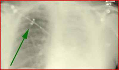 Expat World Philippines HEALTH PROJECT: Man has pea plant growing in ...