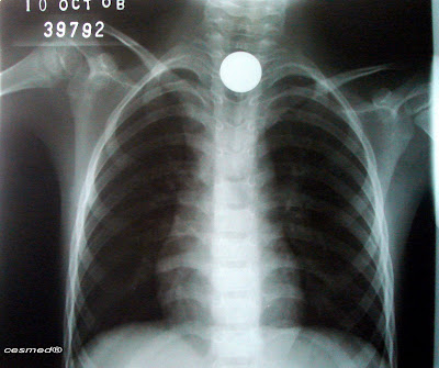 CESMED: CUERPO EXTRAÑO EN ESOFAGO