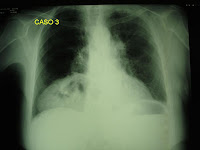 ALFREDO JIMÉNEZ BERNADÓ: HERNIA DE LARREY MORGAGNI: TRATAMIENTO POR ...