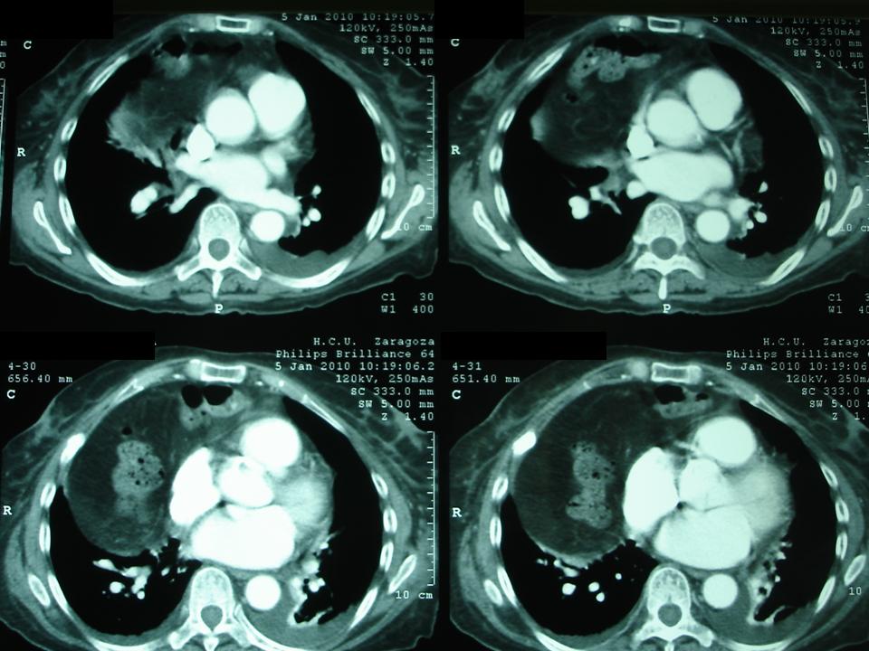 ALFREDO JIMÉNEZ BERNADÓ: HERNIA DE LARREY MORGAGNI: TRATAMIENTO POR ...