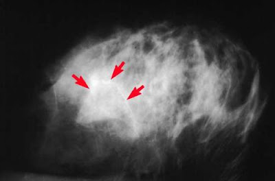 Fact About Breast Cancer: Diagnostic Mammogram