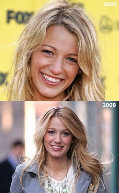 Miranda Lambert Buzz Blake Lively Nose Job Before And After
