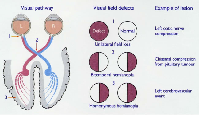 uMiE-tOmOyO: tdg hitam bitemporal hemianopia