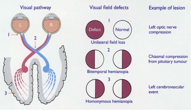 uMiE-tOmOyO: tdg hitam bitemporal hemianopia