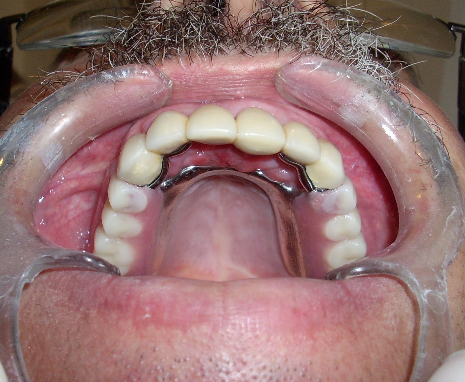Odontología estética integral y Cirugía Bucomaxilar: PRÓTESIS FIJA ...