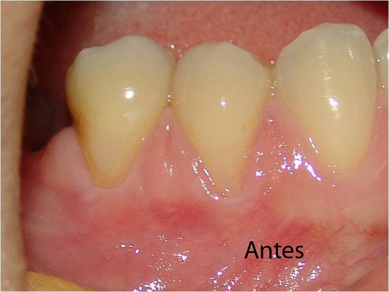 Periodontista Luciane Rossatto Silveira: Enxertos gengivais livres