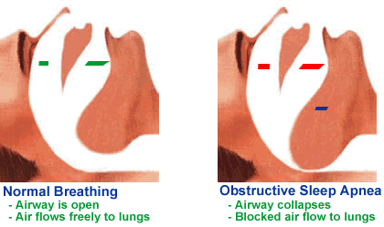 wajib sehat: Obstructive Sleep Apnea