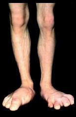 special treatment: Akromegali