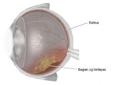 Ablasio Retina - Terapi Sehat : Info Kesehatan Medis dan Alternatif