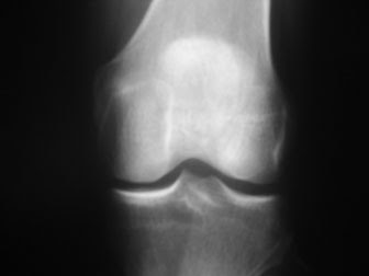 The Real Just: Bruised Knee Cap...