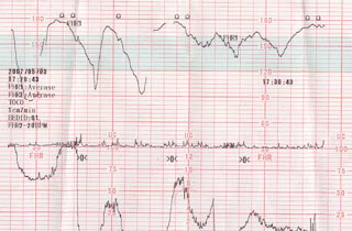 Preganancy and Child Birth: Cardiotocogram (CTG)