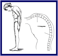 Captains Medic Photos: Ankylosing Spondylitis (Αγκυλωτικη Σπονδυλιτιδα)