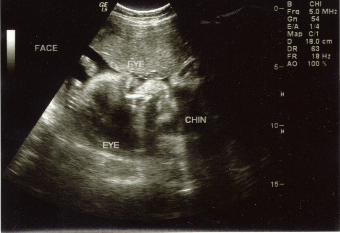 The Schmitt Family: Pregnancy Update - Week 31