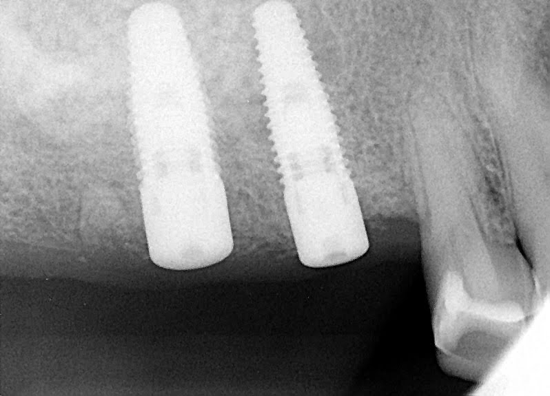 Periodontal - Implant Cases by Dr. Thomas Kang: Sinus Elevation with ...