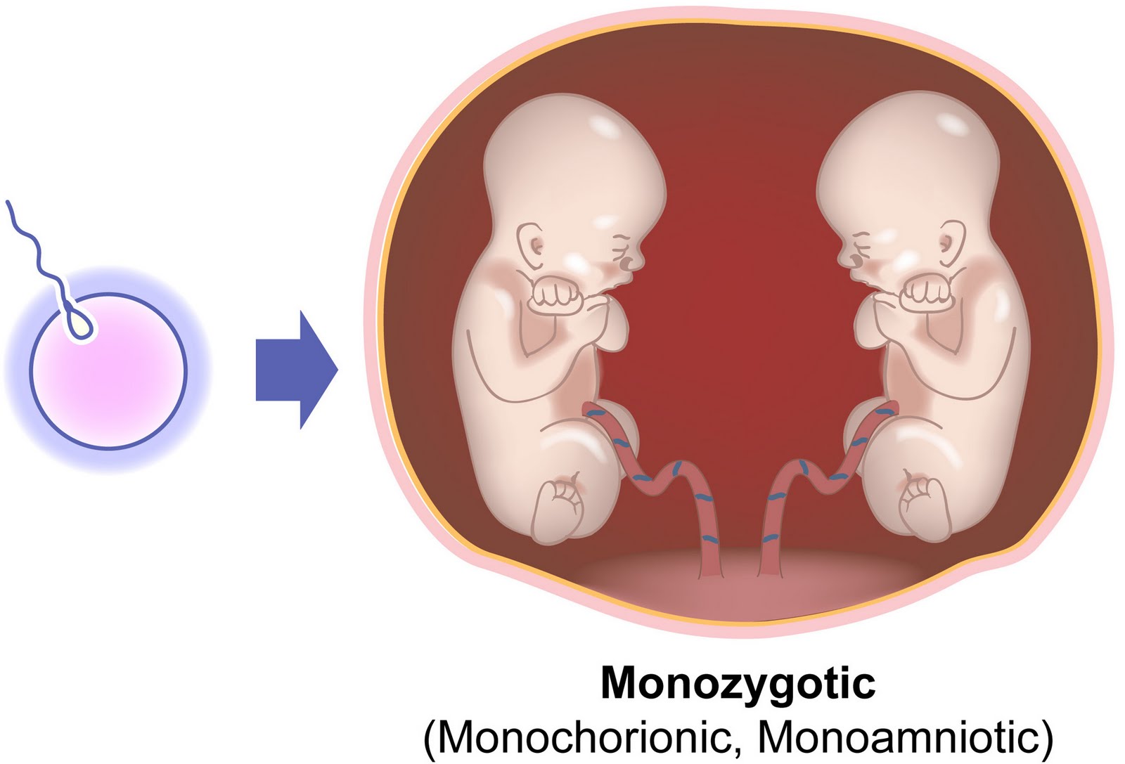 My Monoamniotic Twin Journey: 2010