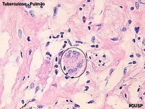 biomedicpatology: IMAGENS DE INFLAMAÇÕES CRÔNICAS E GRANULOMAS