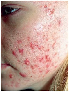 Medical Textbook in The Net: Acne Vulgaris