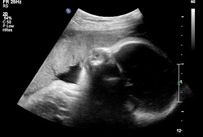 :: OUR FAMILY ::: 32 Week Ultrasound