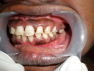 Aggressive Periodontitis | Iqbalsandira