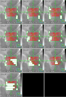 IMRT Intensity-Modulated Radiation Therapy: Segmental o step-and-shoot IMRT