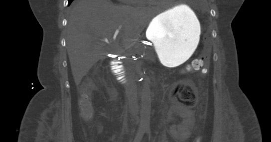 Buckeye Surgeon: Afferent Loop Syndrome