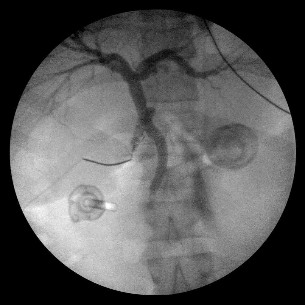 Buckeye Surgeon: Laparoscopic CBD Stone Extraction