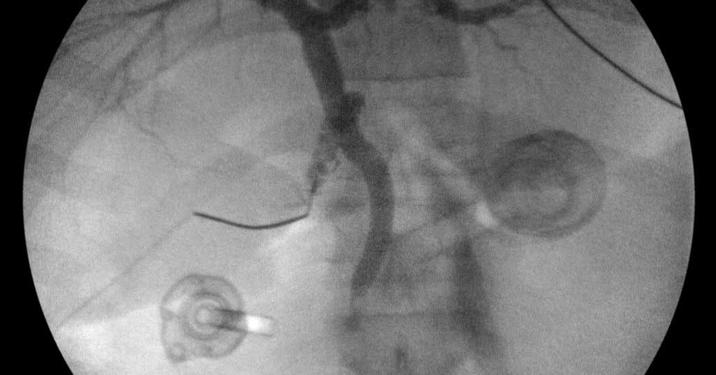 Buckeye Surgeon: Laparoscopic CBD Stone Extraction