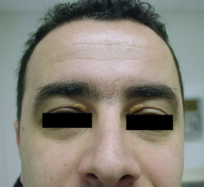 The Fat Guy Experience: Cholesterol Plaques