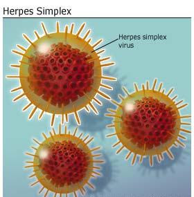 ATLAS OF DISEASES: Herpes Simplex