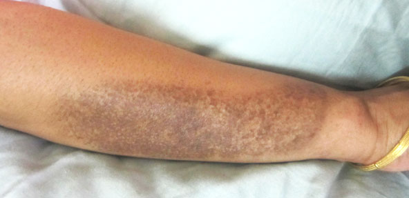 [Skin Concerns] Hot oil burn... best way to treat it? : SkincareAddiction