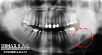 DIAGNOSTICOS POR IMAGENES: Defecto Óseo de Stafne