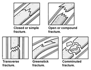 Musculo-Skeletal Nursing: Types of Fractures