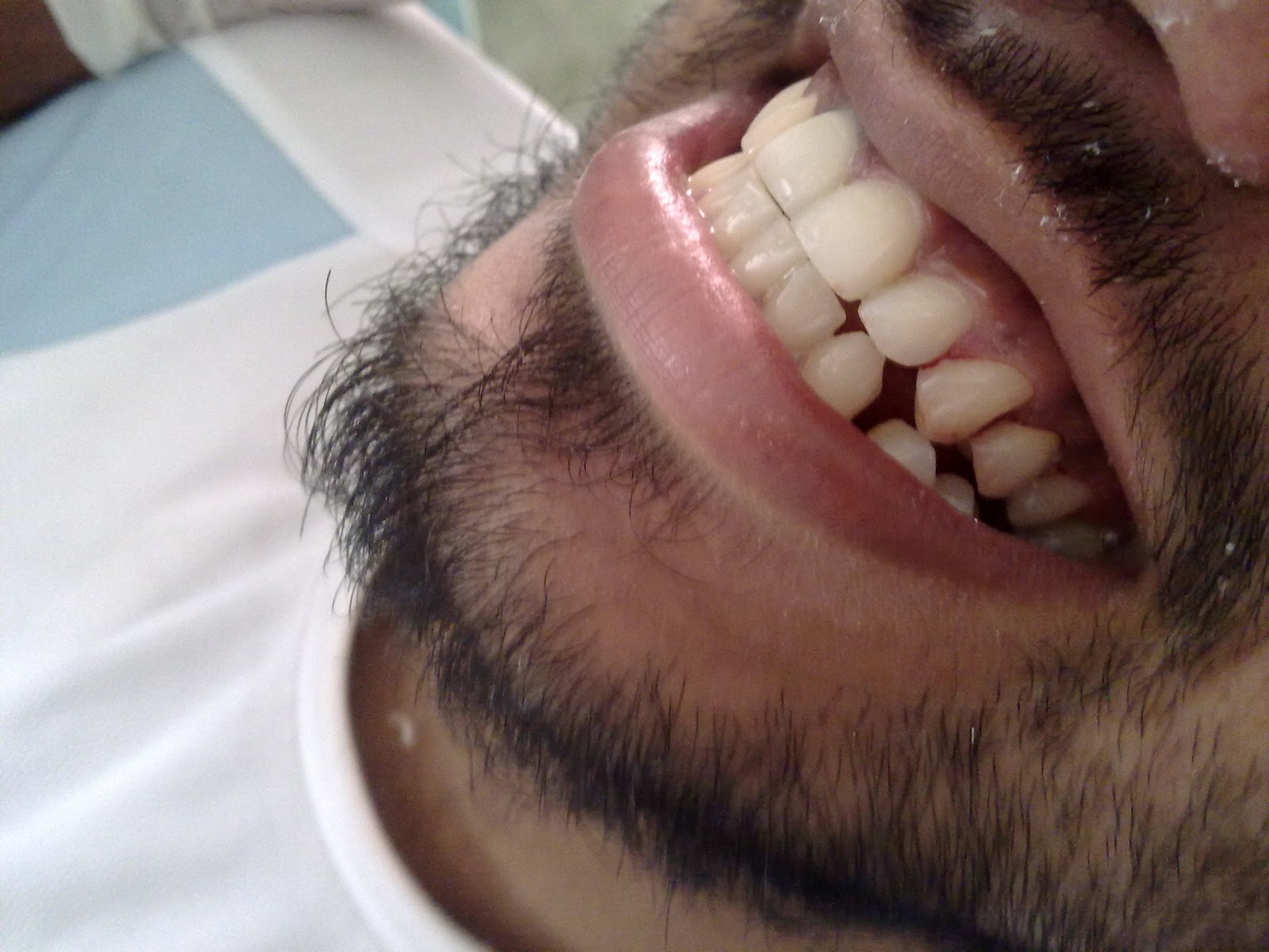 DENTO CARE DENTAL CLINICS: 3M LAVA CROWN-ANTERIOR RESTORATION