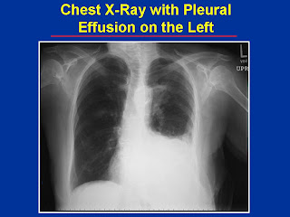 Medical Review: EFUSI PLEURA