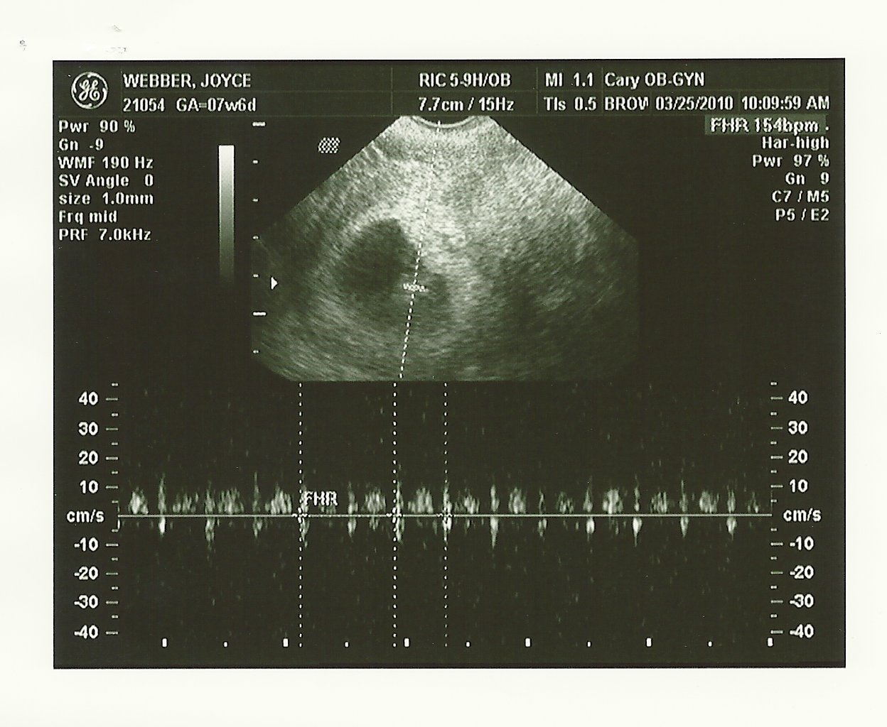 Two for One Special: 8 Week Ultrasound Pictures