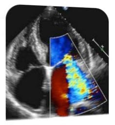 Aliasing to Heaven: Vena Contracta
