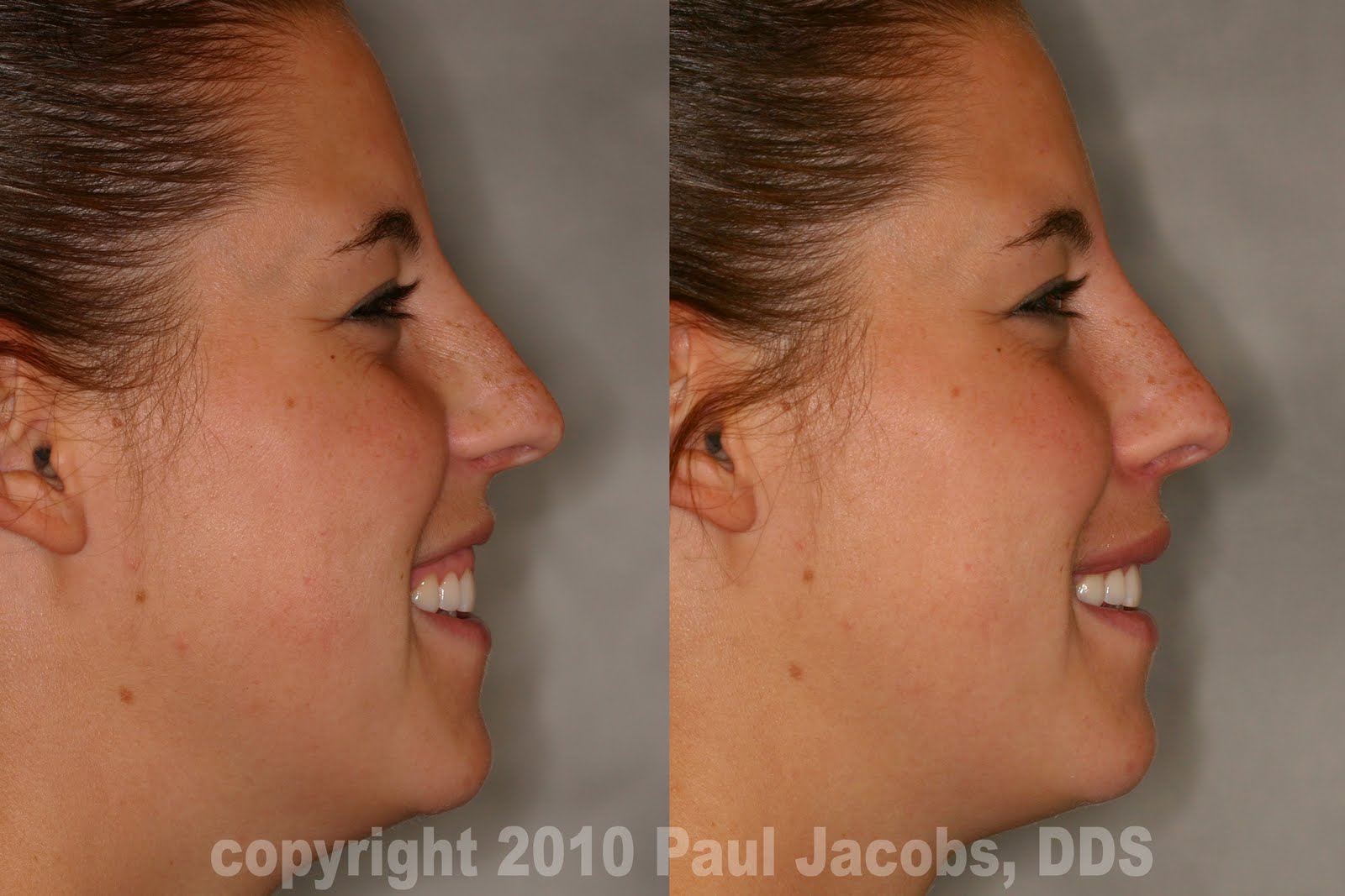 Dental Nation: Reversible Lip Repositioning Surgery