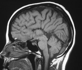 Agenesis Corpus Callosum: Reading and Comprehension