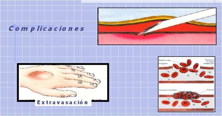 Punciones y Cateterismos Vasculares: COMPLICACIONES DEL TRATAMIENTO I.V.