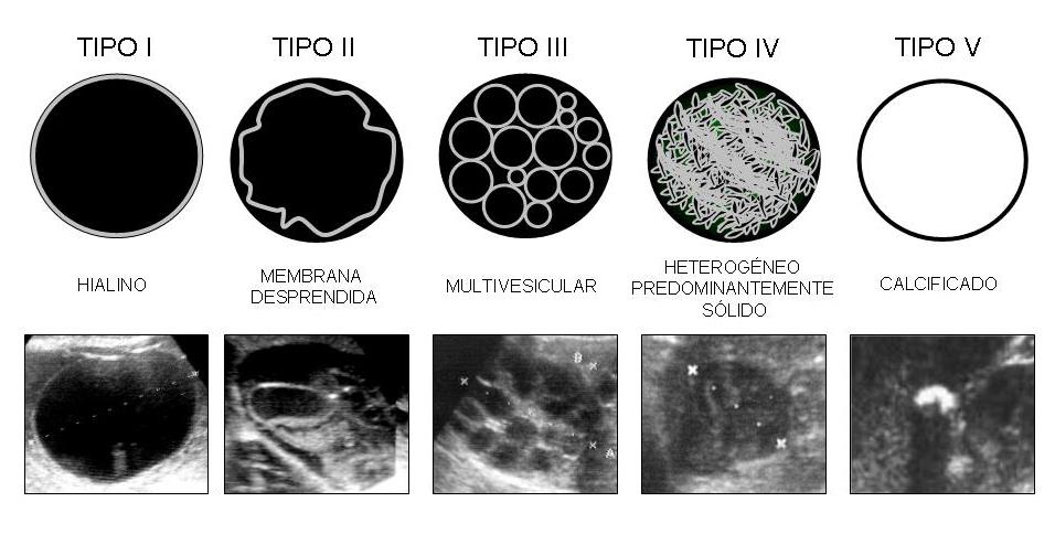 El Endoscopista: Quiste hidatídico. clasificación ecográfica