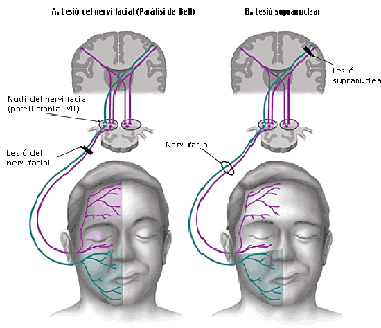 Medicina APS: Parálisis de Bell