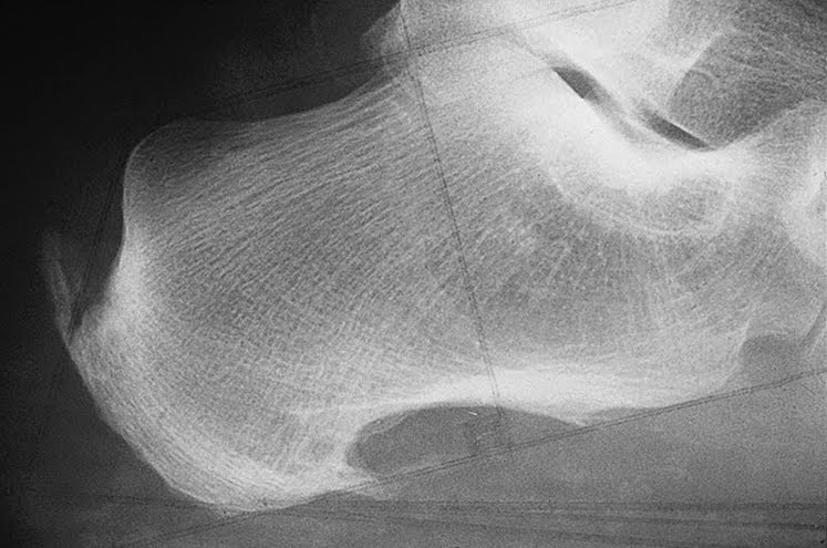 Medicina APS: Mujer de 45 años con Talalgia unilateral