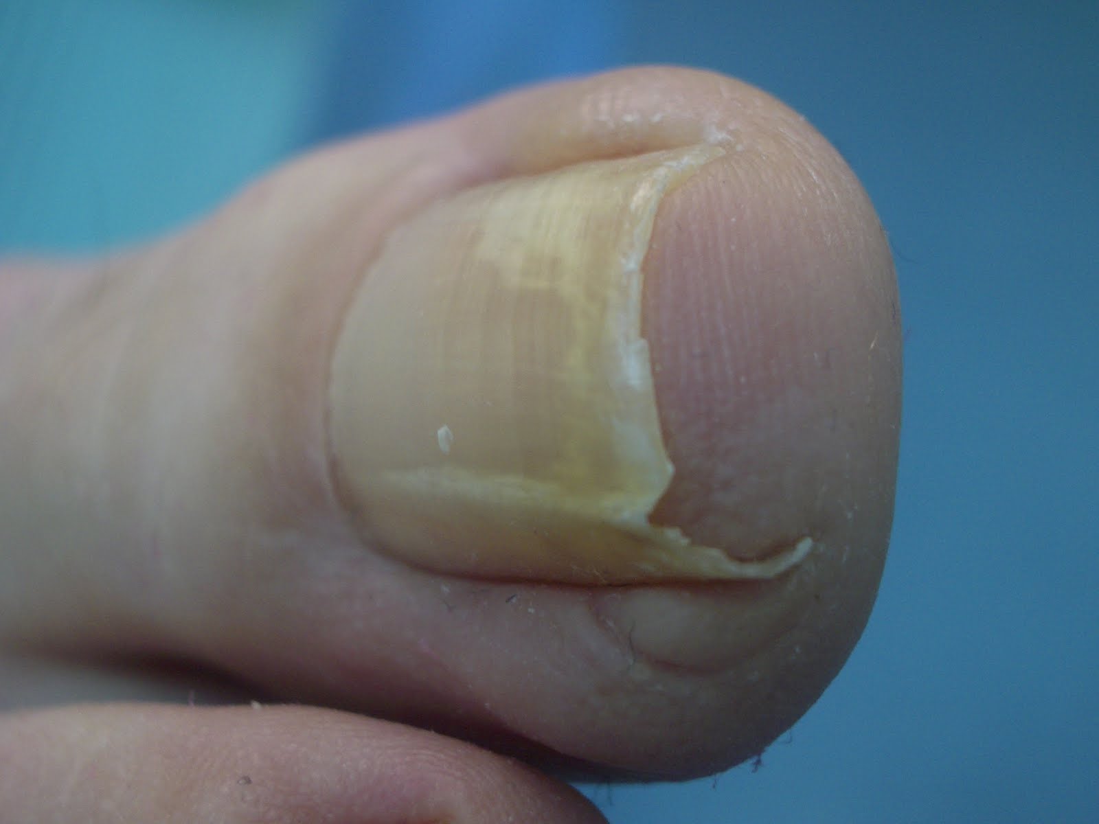 Podo Basas al Día: Onicocriptosis. Papiloma. Infección. Enohorabuena ...