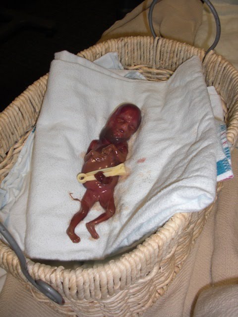 Miscarriage 7 weeks, Stillbirth 19 weeks, and Hope for a new life ...