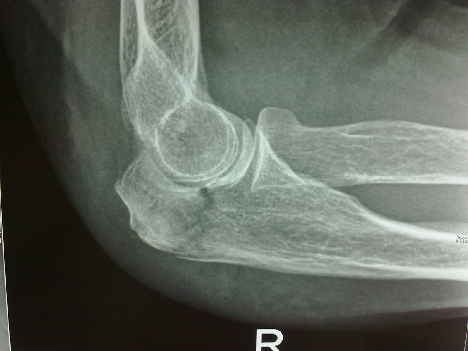 CLINICA DE GERIATRIA ON-LINE: FRACTURA DE OLÉCRANON