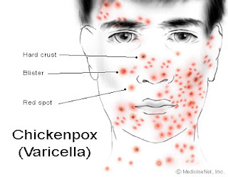 More to what meets the Eye.: Chicken Pox: What you may not know about it.